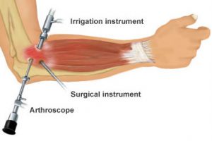 Tennis elbow surgery and treatment | Montreal, Toronto, Ottawa, Gatineau