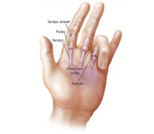 Trigger finger endoscopic treatment | Montreal, Toronto, Ottawa, Gatineau