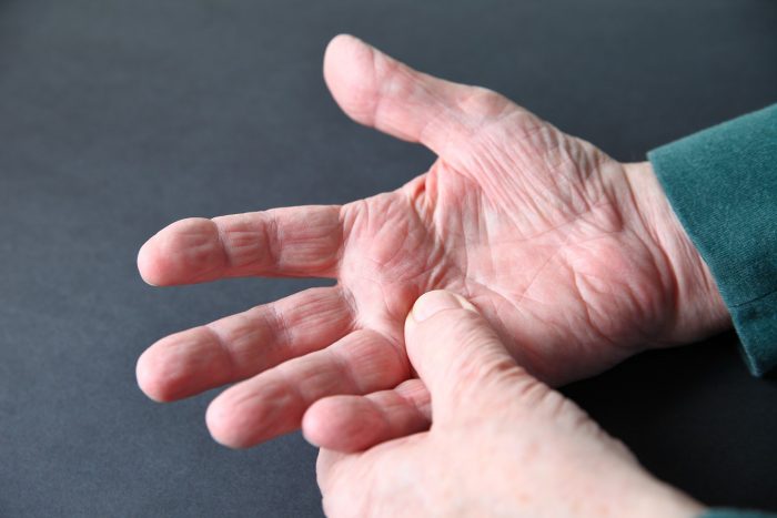 Dupuytren's Contracture Treatment Montreal | Hand Specialist
