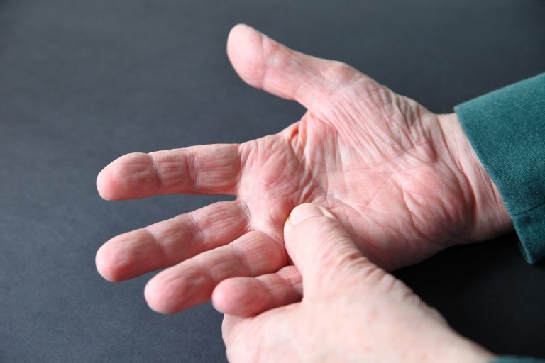 Dupuytren's Contracture Treatment Montreal | Hand Specialist